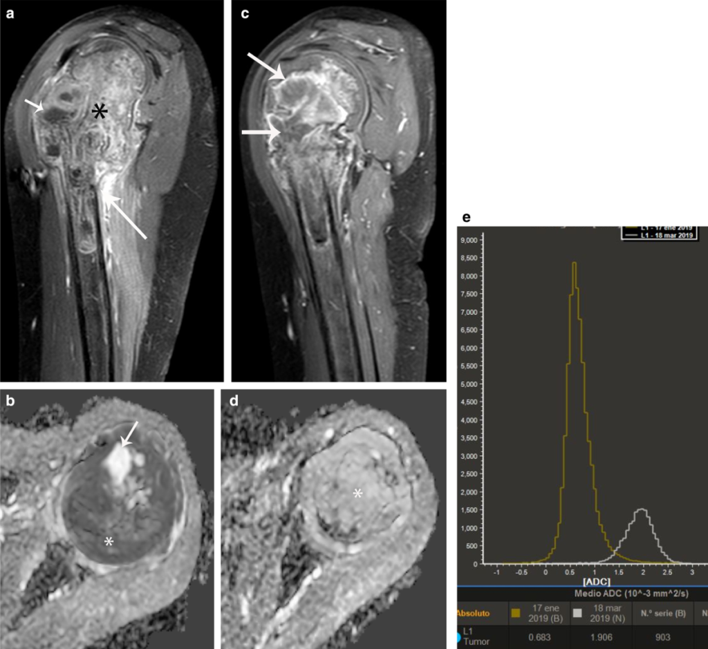 ALL YOU NEED TO KNOW ABOUT SARCOMAS(BONE& SOFT TISSUE CANCER ...